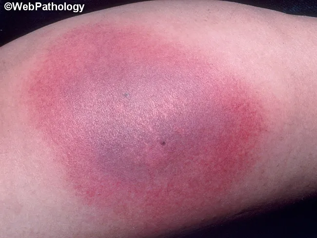 Fixed Drug Reaction : Bactrim