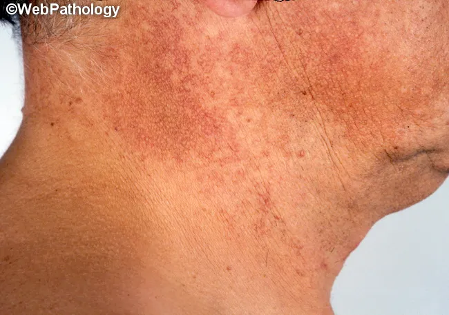 Allergic reaction : After Shave Lotion