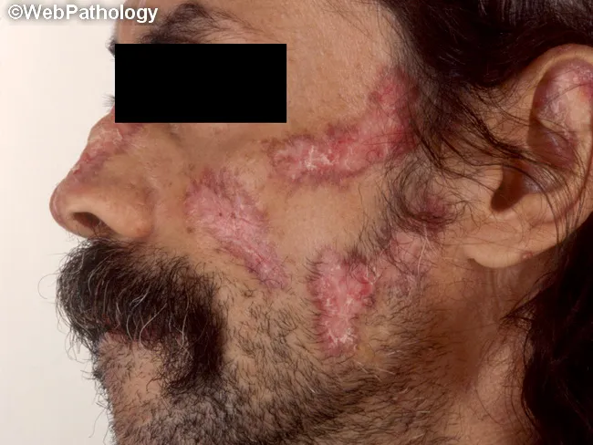 Discoid Lupus Erythematosus : Clinical Features