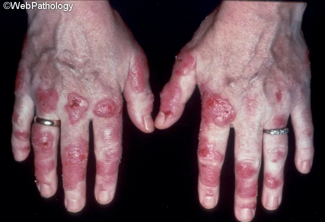 Discoid Lupus - Generalized