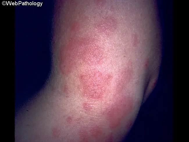 Discoid Lupus - Generalized