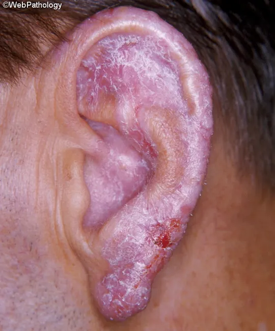 lupus ear problems