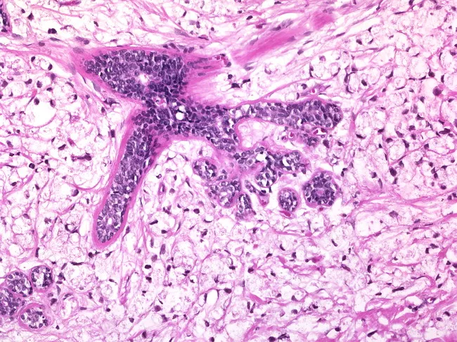 Signet Ring Cell Carcinoma of Breast