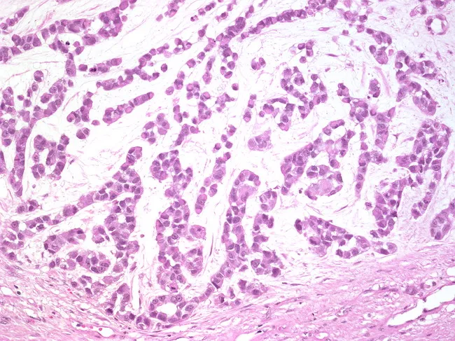 Signet Ring Cell Carcinoma of Breast