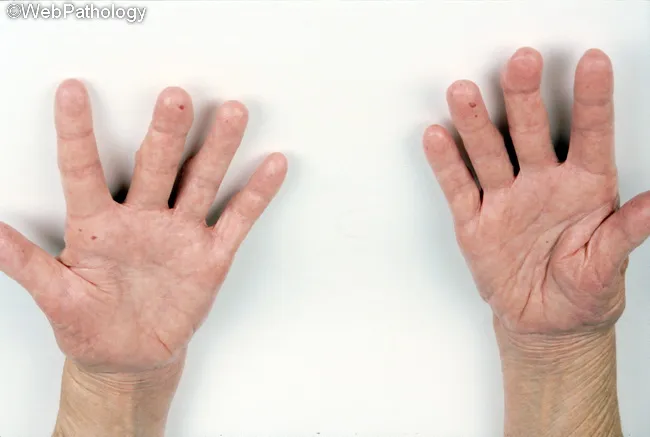 Limited Scleroderma : CREST Syndrome