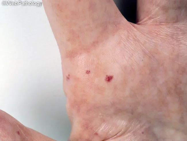 Limited Scleroderma : CREST Syndrome