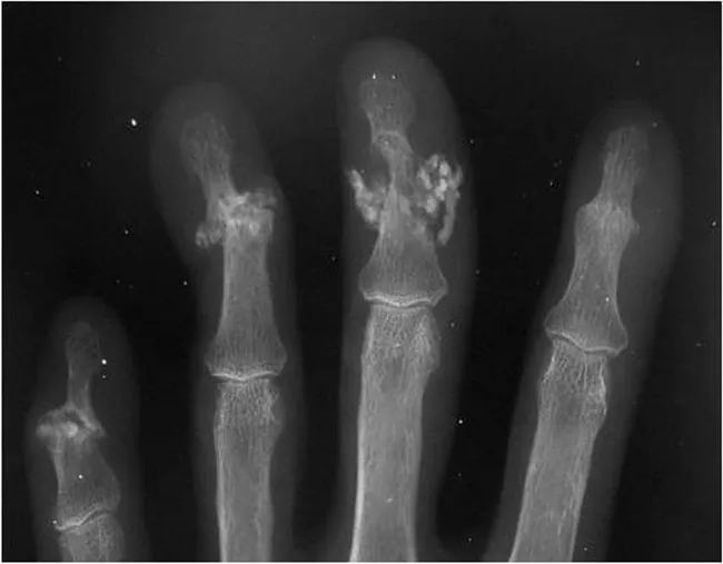 Systemic Sclerosis : Radiology
