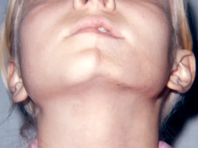generalized morphea scleroderma