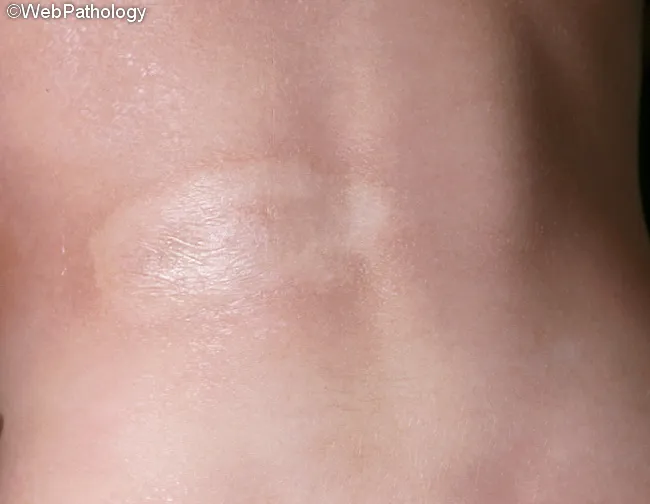 Localized Scleroderma : Morphea