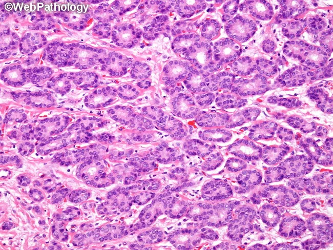Breast Cancer : Luminal A