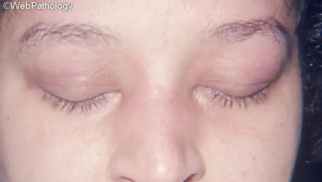 Dermatomyositis