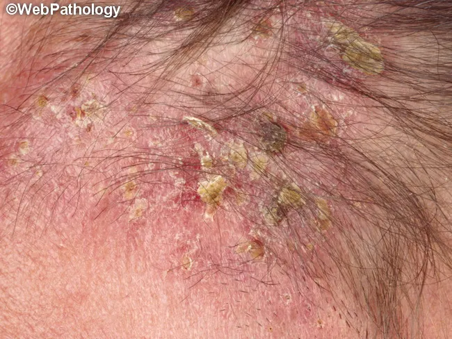 Impetigo