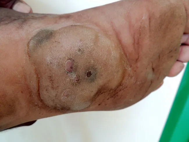 Mycetoma : Clinical