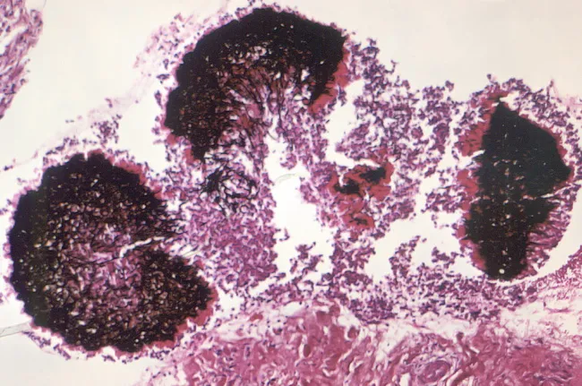 acremonium falciforme