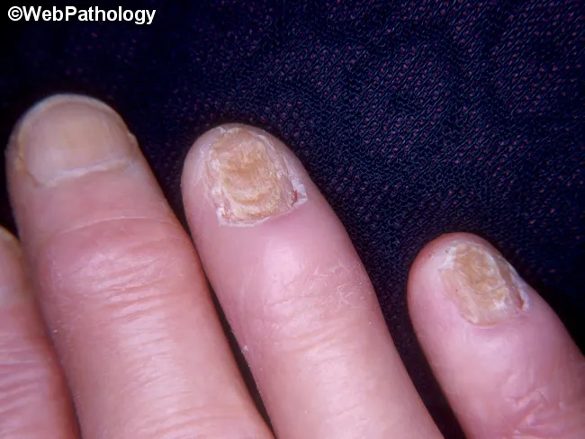 Nail Dystrophy : Diabetes