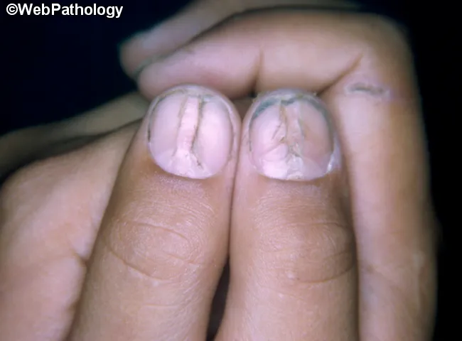 Median Canaliform Dystrophy