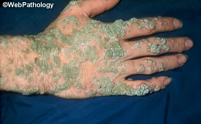 cutaneous warts nice