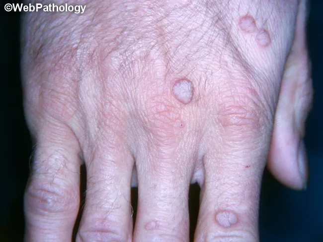 Common Wart (Verruca vulgaris)