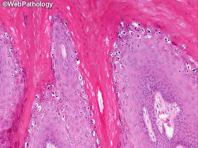Verruca Vulgaris Histology A Rare Case Of Large, Unusual, And