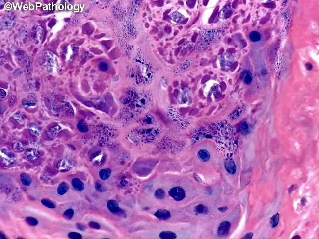 Verruca Plantaris Histology Verruca Vulgaris