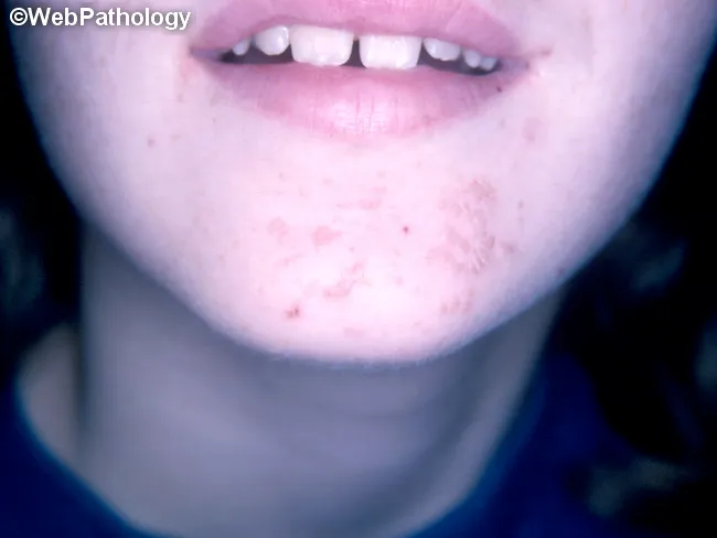 Plane Warts (Verruca Plana)