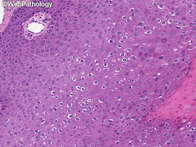 Condyloma Acuminata : Microscopic