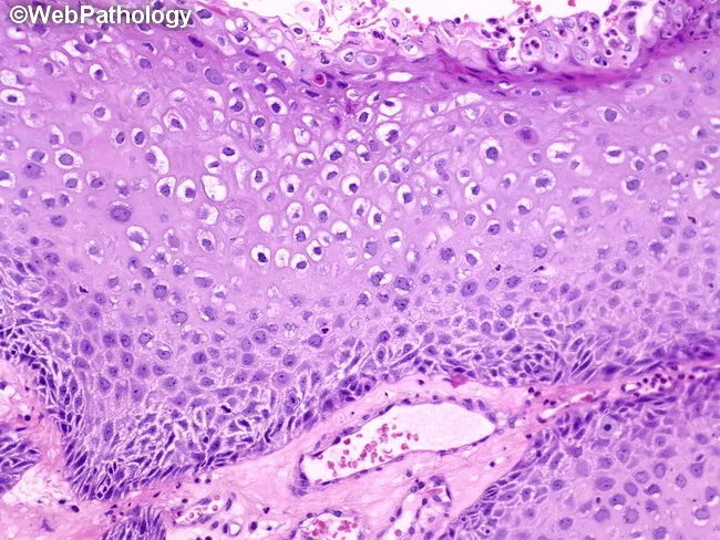 Condyloma Acuminata : Treatment