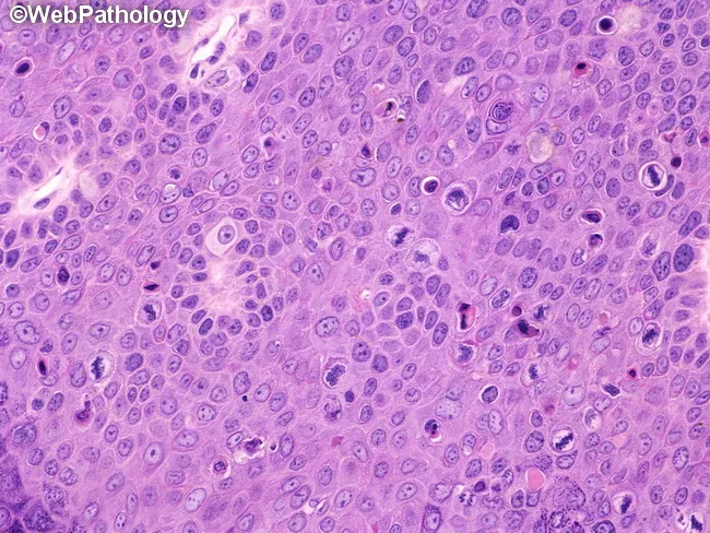 Condyloma : Podophyllotoxin Treatment