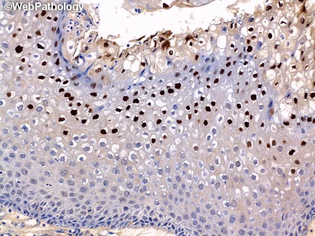 Condyloma Acuminata : Immunohistochemistry