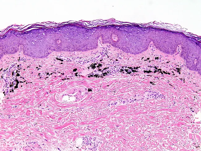 Epidermodysplasia Verruciformis : Introduction