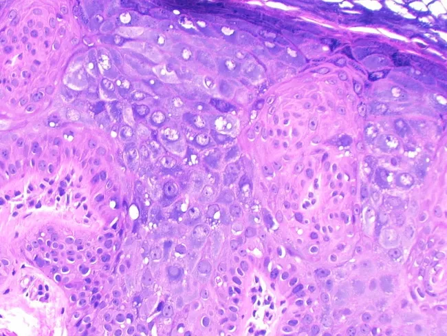Epidermodysplasia Verruciformis Histologi Epidermodysplasia