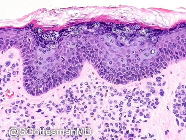 Epidermodysplasia Verruciformis : Incidental
