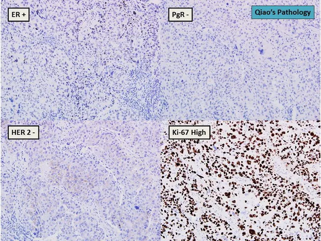 Breast Cancer : Luminal B