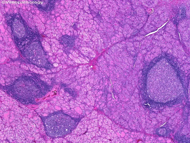 subacute thyroiditis pathology outlines