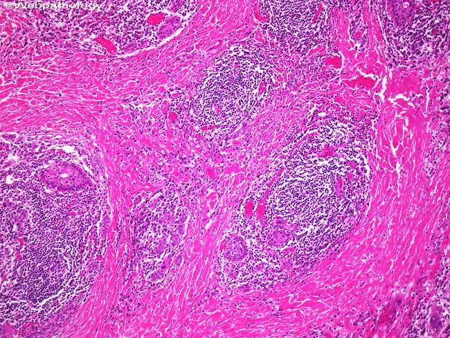 Hashimoto Thyroiditis - Fibrous Variant