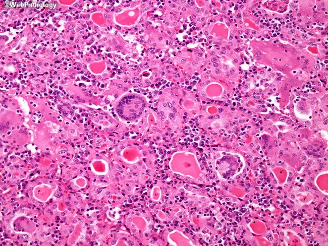 Granulomatous Thyroiditis