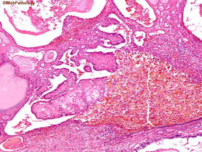 Multinodular Goiter