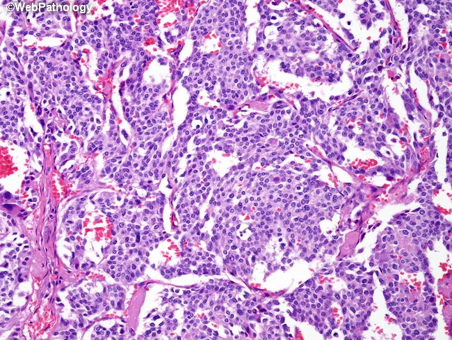 thyroid medullary carcinoma amyloid