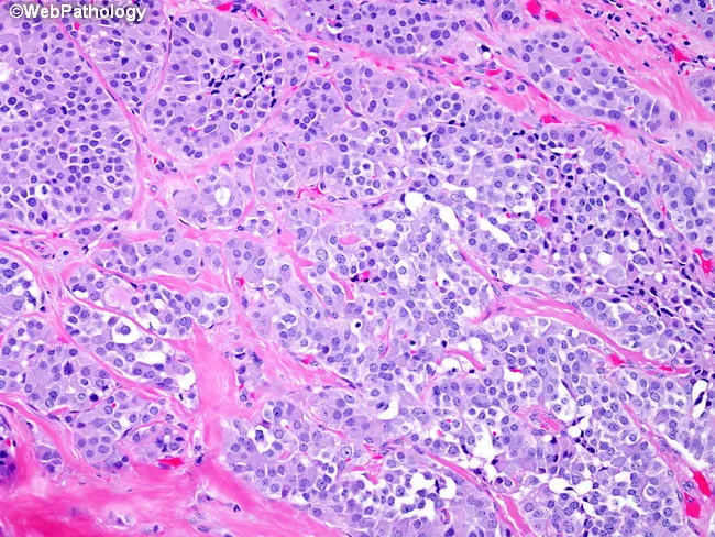 thyroid medullary carcinoma amyloid