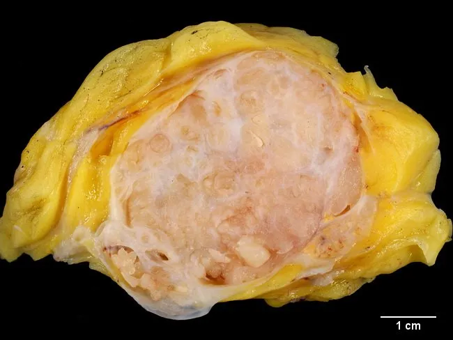 Phyllodes Tumor : Low-grade