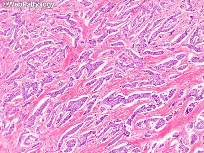 PanNET : Clinical Features