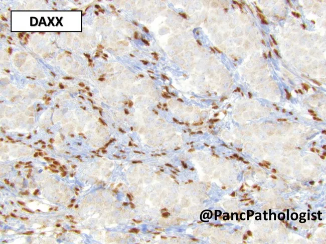 PanNET : Molecular Genetics