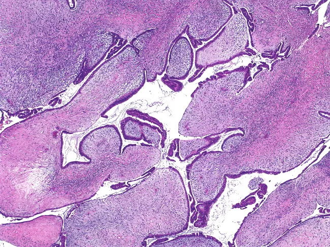phyllode tumor benign