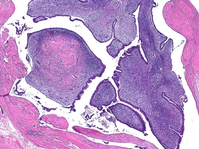 Phyllodes Tumor : Low-grade
