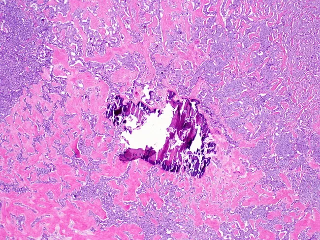 PanNET : Calcification