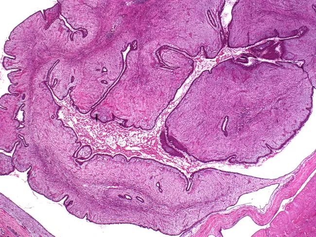 Phyllodes Tumor : Low-grade