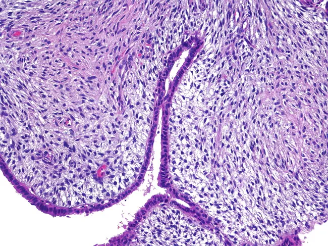 Phyllodes Tumor : Low-grade
