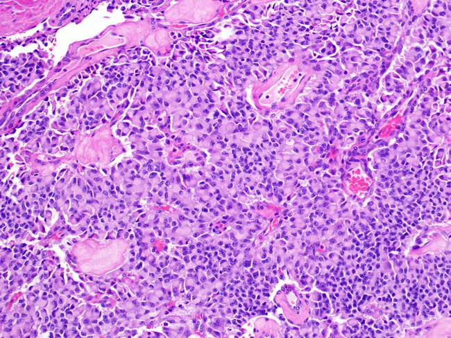 PanNET : Rhabdoid Variant