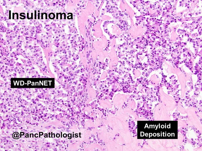 Insulinoma : Microscopic Features