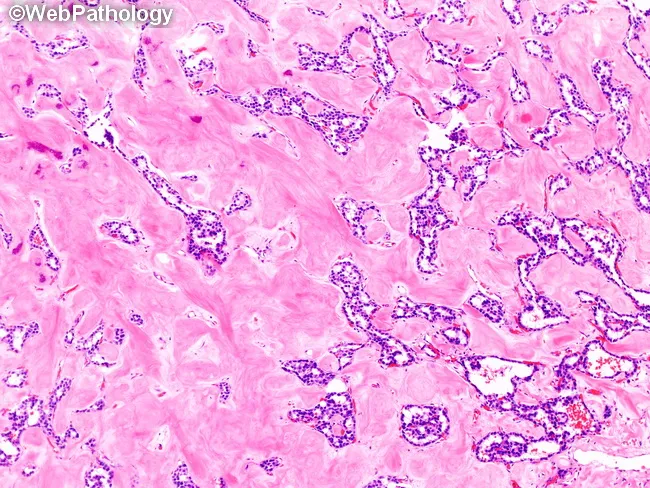 Glucagonoma : Differential
